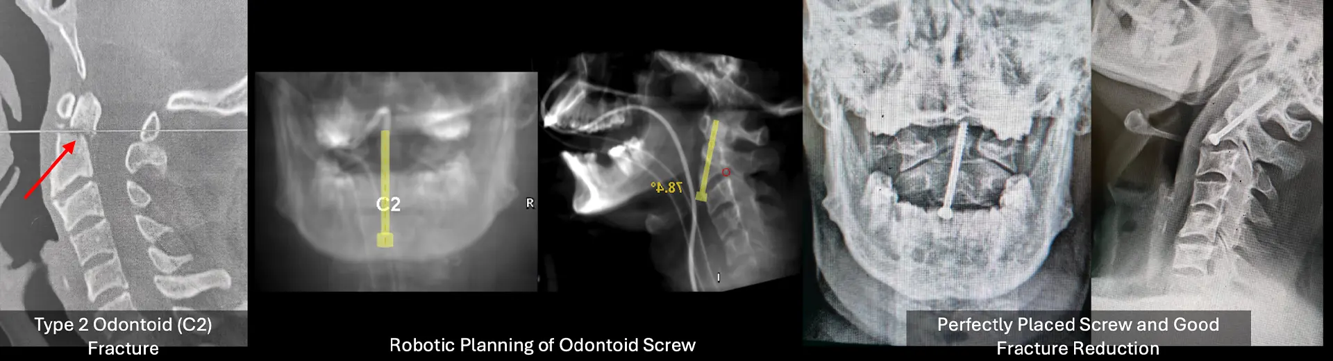 Anterior Odontoid Screw Fixation Surgery