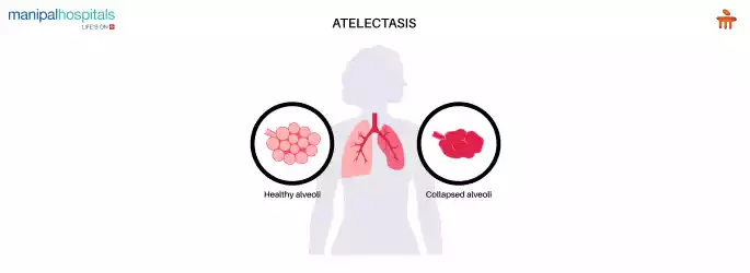 is atelectasis bad